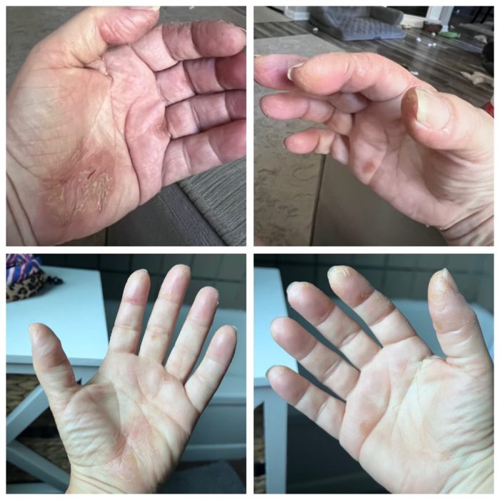 Eczema and Probiotic Foods - Cultured Food Life